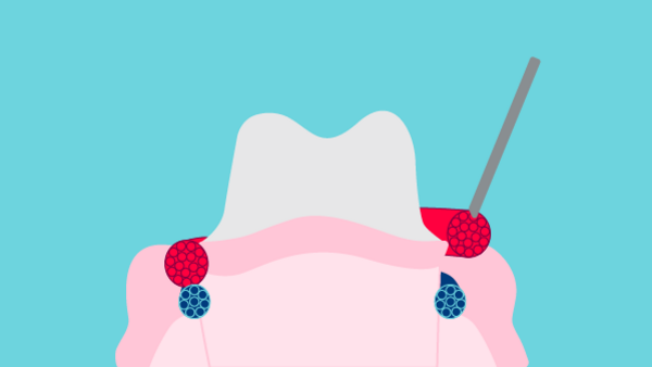 Gingival expander RAUMEDIC Cupcake – RAUMEDIC