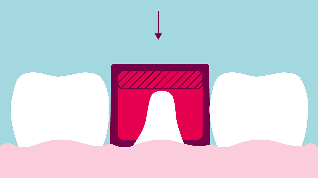 Gingival expander RAUMEDIC Cupcake – RAUMEDIC